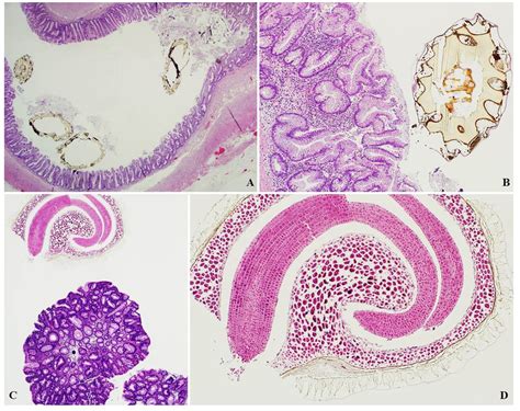 A Kiwi Seeds Within A Distended Appendix With Serrated Lesion Hande