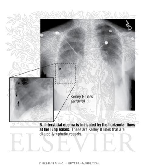 Search Strategy Lungs Alveolar Vs Interstitial Opacity