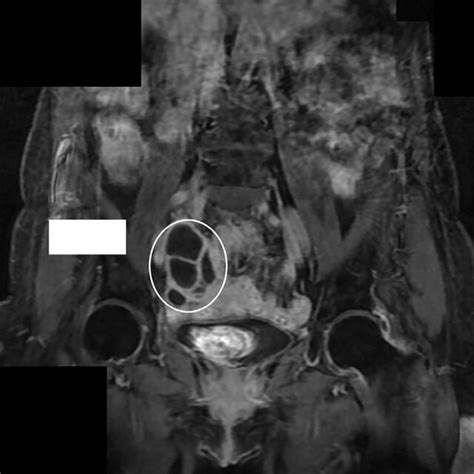 Pelvic Magnetic Resonance Imaging Multicystic Right Ovarian Mass Circled Download Scientific