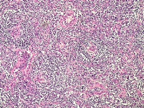 Histopathology Increased High Endothelial Venules Download Scientific Diagram
