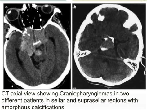 Physiological And Pathological Calcification Of Brain Pptx