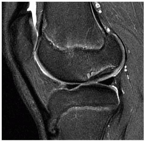 Arthroscopic Microfracture Of Osteochondritis Dissecans Lesions Of The