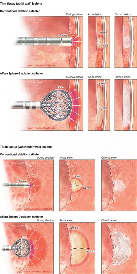 Farawave Af Ablation Ami Meeting 2020