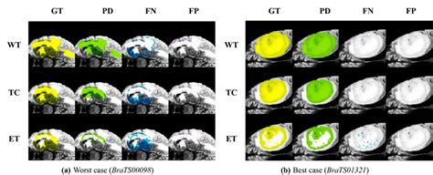Segmentation Of Wt Tc And Et By Net1 Net3 Of Mri Images In Flair Download Scientific Diagram