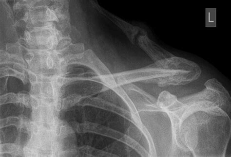Normal Clavicle Xray