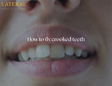 How To Fix Crooked Teeth Expert Sheffield Dentist Advice