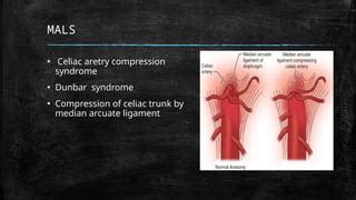 Median Arcuate Ligament Syndrome With Celiac Stenois Pptx