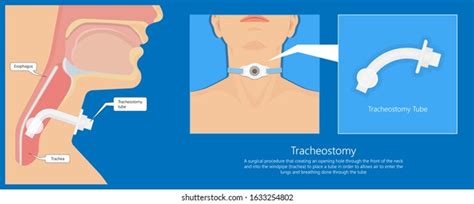 Tracheostomy Care Over 226 Royalty Free Licensable Stock Illustrations