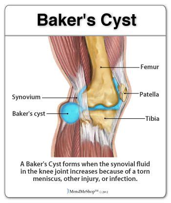 Bakers Cyst A Ganglion Cyst Or Synovial Cyst Can Occur In Any Joint