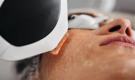 Pcos And Excess Facial Hair Is Laser Hair Removal The Answer Primary