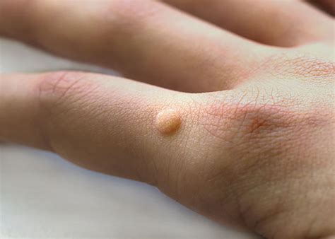 Common Warts Verruca Vulgaris Mclean Va And Woodbridge Va Skin And Laser Dermatology Center