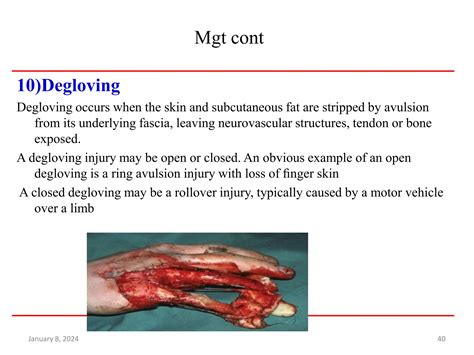 Emergency Wound Mgt Pptx