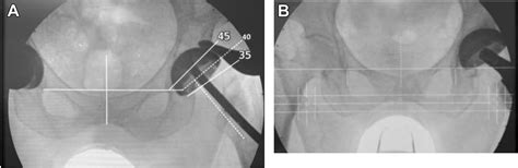 Comparison Of Component Placement Accuracy Using Two Intraoperative