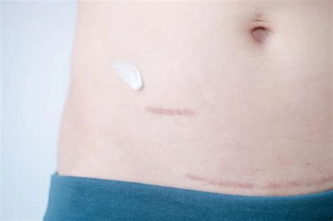 Hypertrophic Scar Vs Keloid Perbedaan Dan Cara Mencegahnya Jac