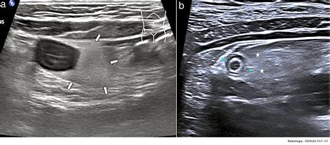 Terminal Ileum Ultrasound