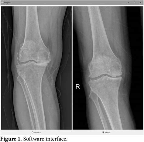 Shortest Time Interval For Detecting The Progression Of Knee