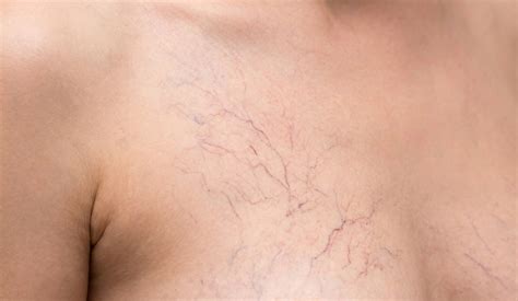 Spider Veins On Chest Spider Veins On Breast Veins In Chest