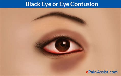 Black Eye Or Eye Contusiontreatmentcausessymptoms