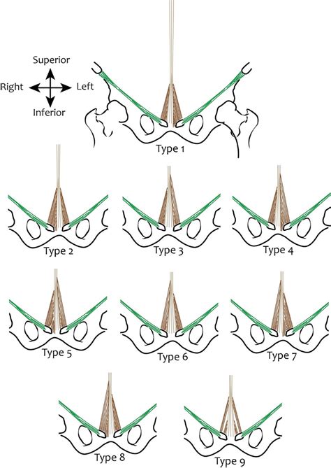 Moris Classification Showing Nine Patterns Of Pyramidalis Download
