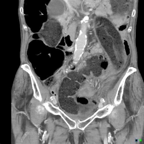 Radiopaedia Case Sigmoid Volvulus Failed Rectal Tube Decompression Id