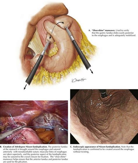 Right Colectomy Basicmedical Key
