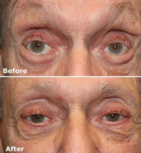 Entropion After Lower Eyelid Surgery Eyelid Surgery For Entropion