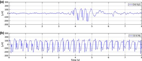 A Typical Eeg Segment Showing An Abnormal Transient B An Download