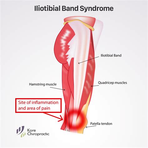 Iliotibial Band Syndrome Surgery Tzbu