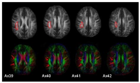 Demarcation Of The Region Of Interest Around The Arcuate Fasciculus In