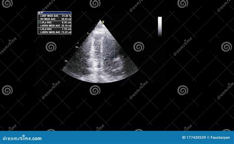 Ultrasound Transesophageal Examination Of The Heart Royalty Free Stock