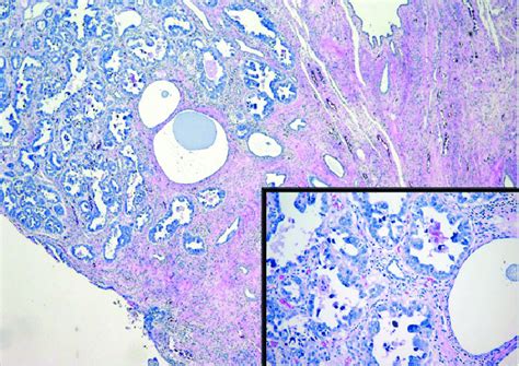 One Serous Papillary Carcinoma Case Is Limited To A Benign Endometrial