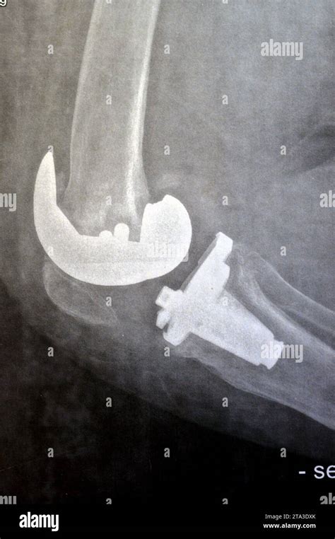 Plain X Ray Showing Total Right Knee Replacement Arthroplasty After