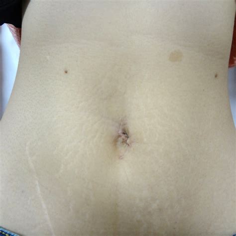 Operative Scar Postoperative 6 Months Download Scientific Diagram