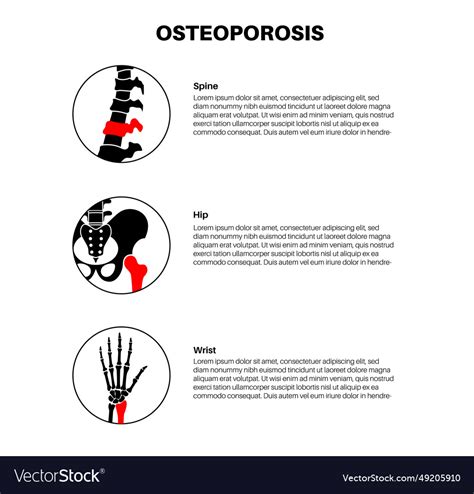 Osteoporosis Medical Poster Royalty Free Vector Image