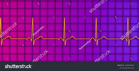 Normal Electrocardiogram Ecg 3d Illustration Displaying Stock
