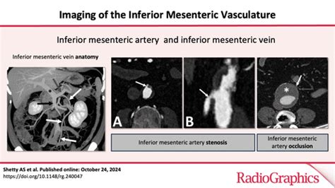 Imaging Of The Inferior Mesenteric Vasculature Radiographics