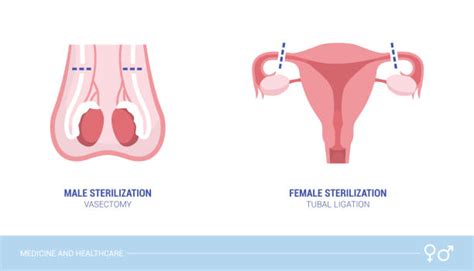 Tubal Ligation Illustrations Royalty Free Vector Graphics And Clip Art