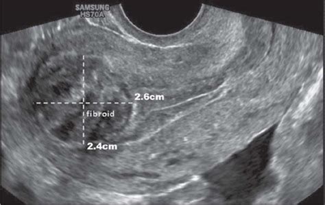 Reporting Of Uterine Fibroids On Ultrasound Examinations An