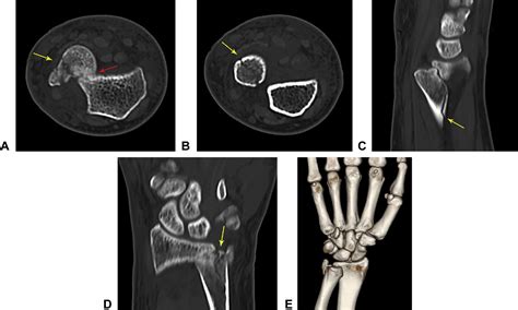Figure 2 From Locked Volar Distal Radioulnar Joint Dislocation Associated With Asymptomatic