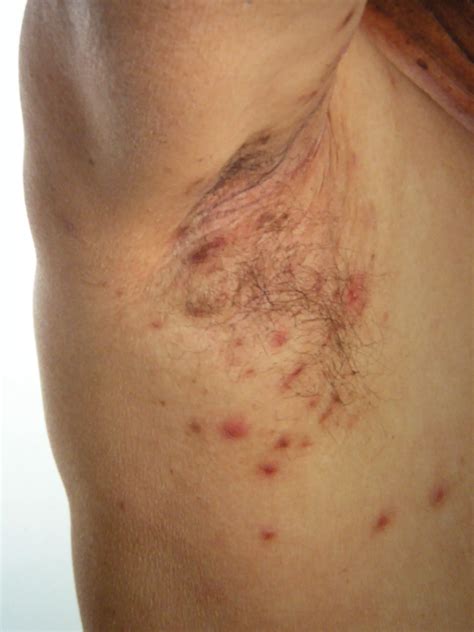 14 Causes Of A Pimple Like Rash