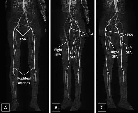 Case Report A Rare Orientation Of Femoral Artery And Vein