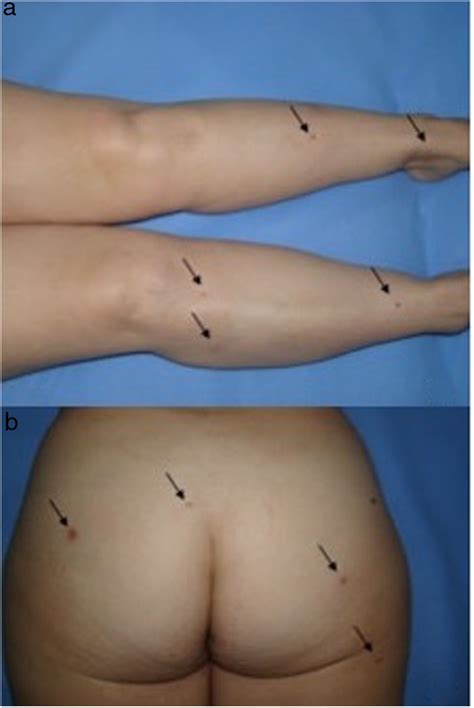 Multiple Eruptive Dermatofibromas In A Patient Treated With Brentuximab