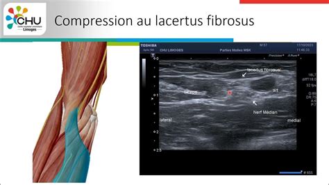 Compression Du Nerf Médian Au Coude Un Cas Clinique Atypique Youtube
