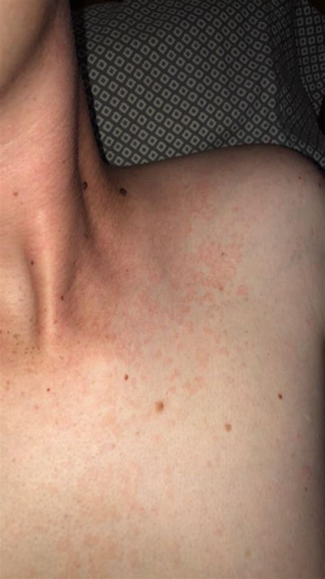 Have These Rashhives Not Sure What The Cause Is They Dont Itch Or