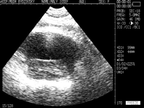 Pancreatic Effusion With A Stripe Of Free Fluid In Acute Pancreatitis