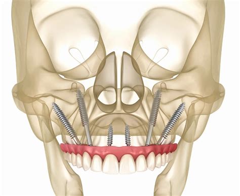 Why Do We Avoid Zygoma Implants All On Four Dental Implants
