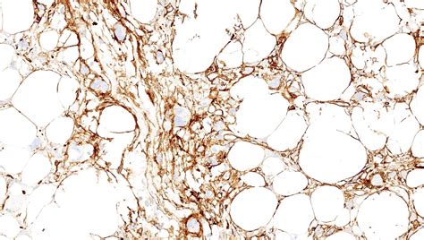 Pathology Outlines Myxoid Pleomorphic Liposarcoma