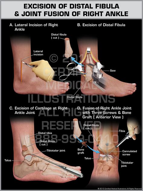 Excision Of Distal Fibula And Joint Fusion Of Right Ankle