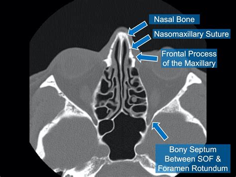 Nasomaxillary Suture
