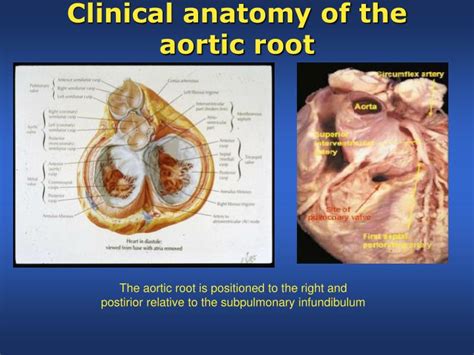 Ppt Aortic Regurgitation And Aortic Leaflet Repair Powerpoint